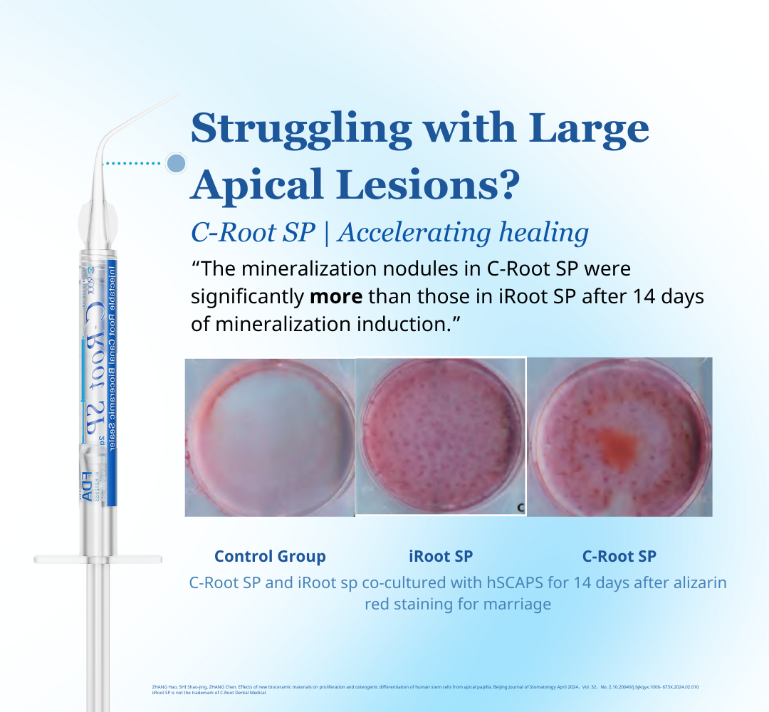 C-Root SP | Bioceramic Root Canal Sealer – C-Root Dental Medical
