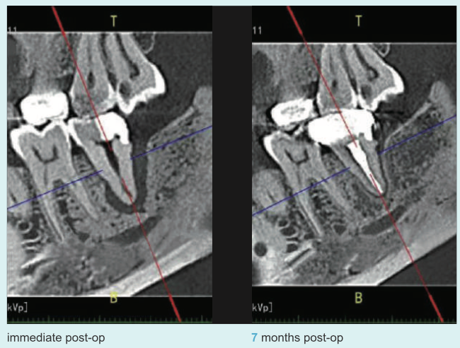 C-Root SP | Strontium-Based Bioceramic Root Canal Sealer – C-Root ...