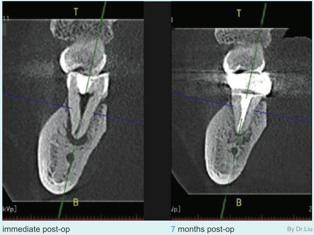 C-Root SP | Strontium-Based Bioceramic Root Canal Sealer – C-Root ...