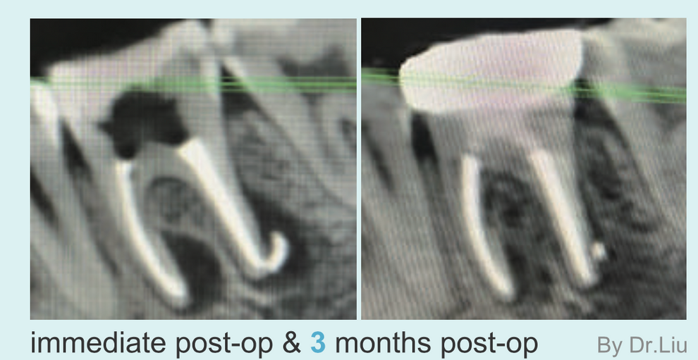 C-Root SP | Strontium-Based Bioceramic Root Canal Sealer – C-Root ...